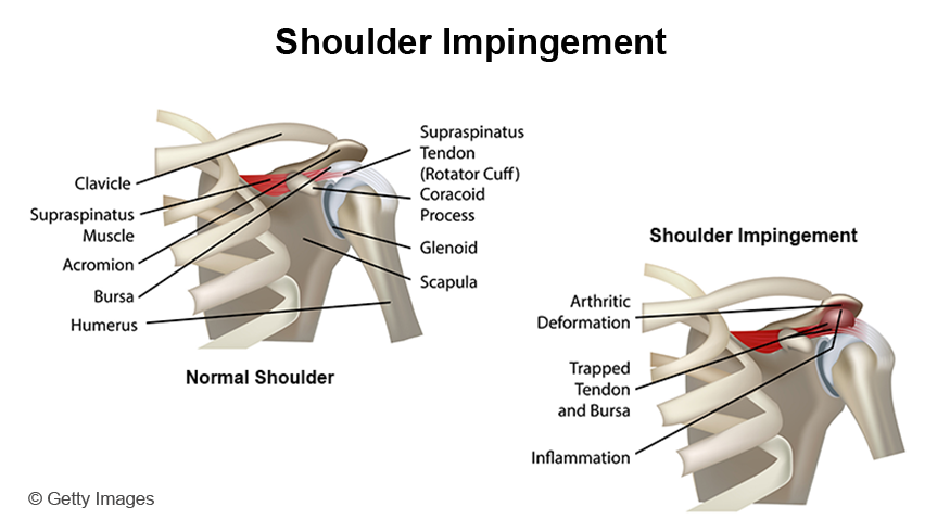 TruMove Guide to Shoulder Impingement Syndrome - TruMove Physical ...